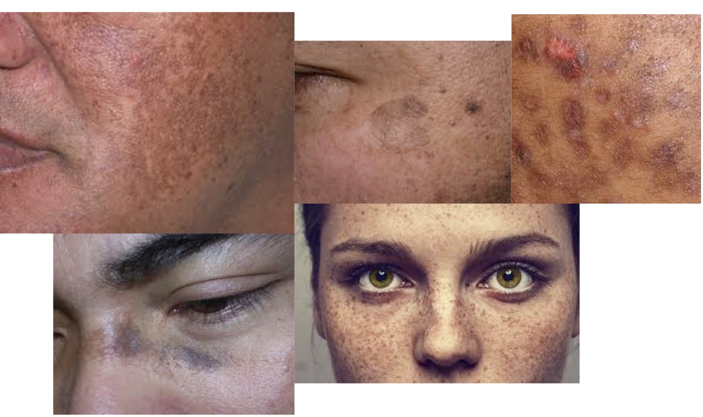 5 Myths About Laser Treatments in Pigmentation – Dr Christie's Beauty Tips